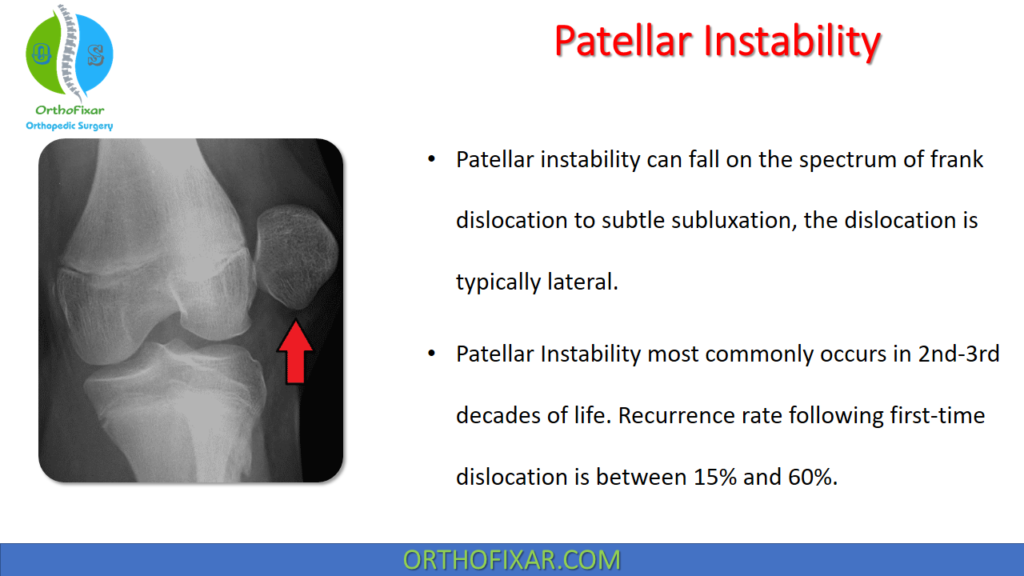 Patellar Instability - Easy Explained | OrthoFixar 2026