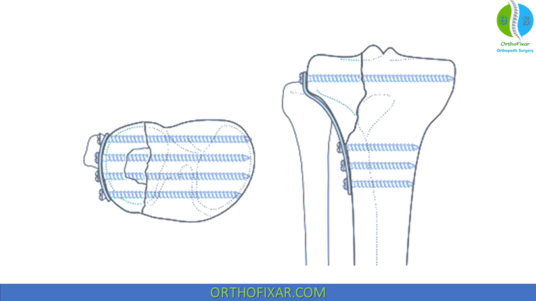 Tibial Plateau Fracture | OrthoFixar