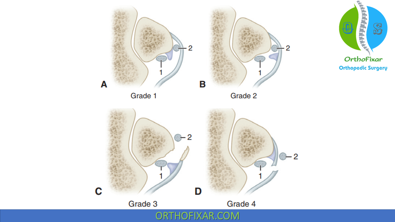 Peroneal Subluxation | OrthoFixar