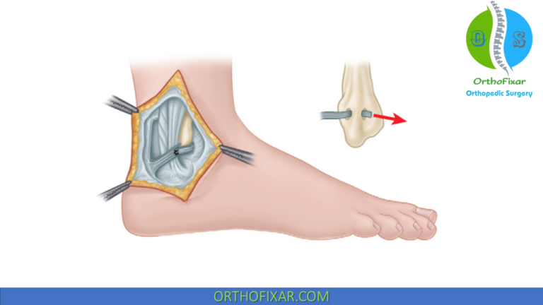 Peroneal Subluxation | OrthoFixar