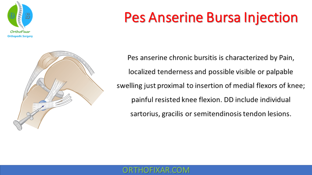 Pes Anserine Bursa Injection Easily Step-By-Step | OrthoFixar
