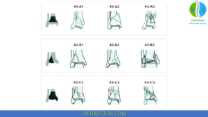 Pilon Fracture | Tibial Plafond Fracture | OrthoFixar