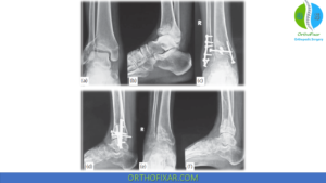Pilon Fracture | Tibial Plafond Fracture | OrthoFixar