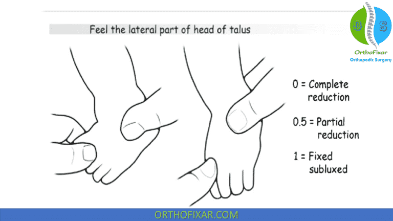 Pirani Score - CTEV | OrthoFixar 2026