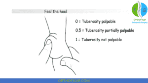 Pirani Score - CTEV | OrthoFixar 2026