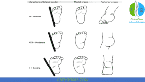 Pirani Score - CTEV | OrthoFixar 2026