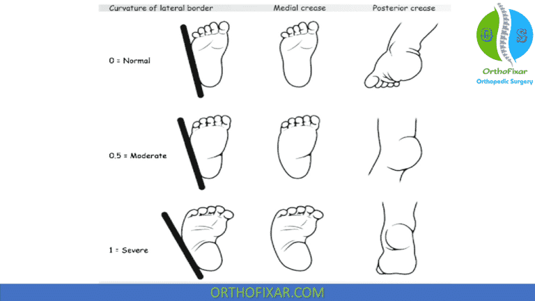 Pirani Score - CTEV | OrthoFixar 2026