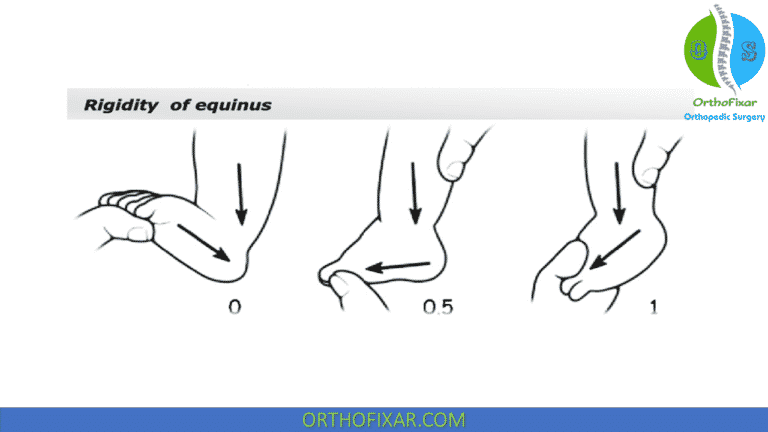 Pirani Score - CTEV | OrthoFixar 2026
