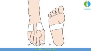 Plantar Fasciitis Taping Technique | OrthoFixar 2025