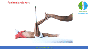 Popliteal Angle Test - Easy Explained | OrthoFixar 2025