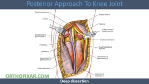 Posterior Approach To Knee Joint Easily Explained | OrthoFixar