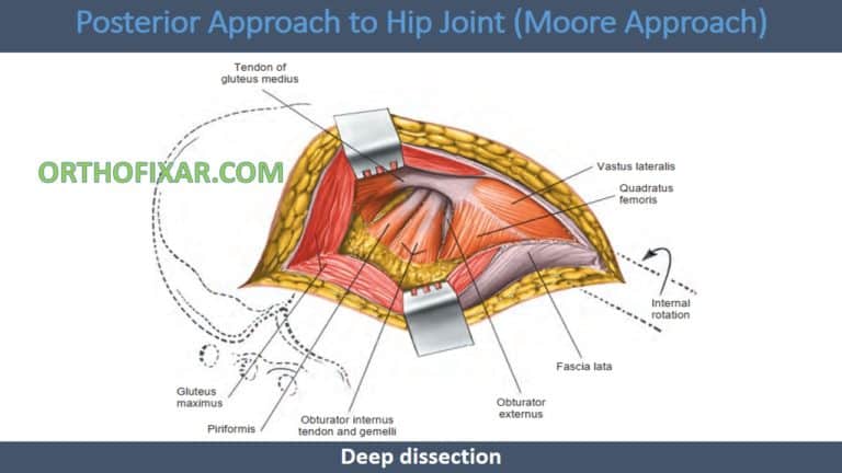 Posterior Approach To Hip Replacement • Easy & Full Tutorial ...