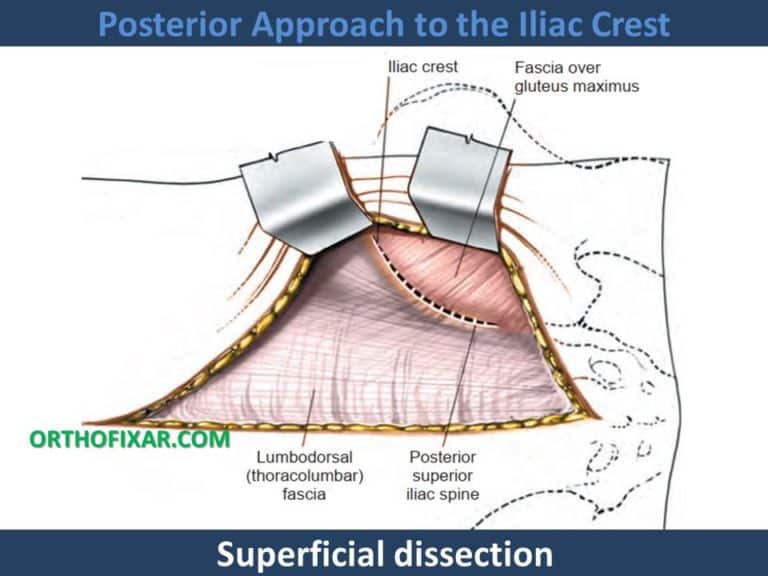 Posterior Approach To The Iliac Crest Easily Explained | OrthoFixar