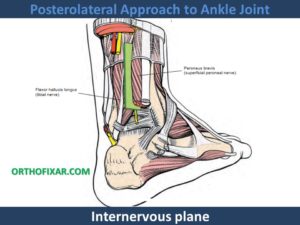Posterolateral Approach To Ankle Joint Easily Explained | OrthoFixar