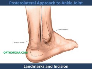 Posterolateral Approach To Ankle Joint Easily Explained | OrthoFixar