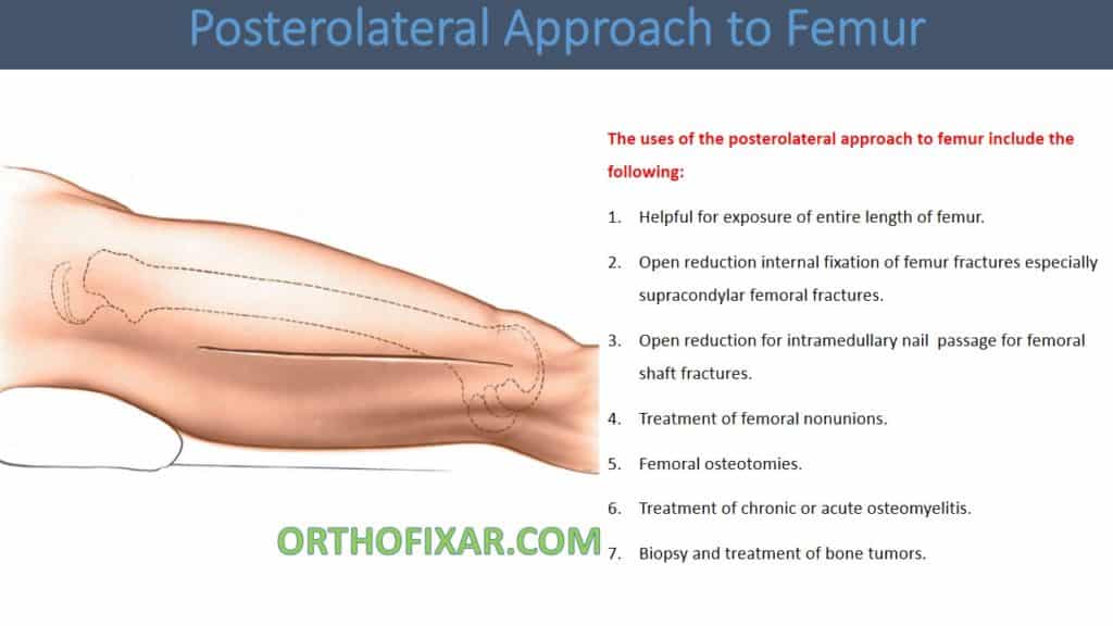 Posterolateral Approach To Femur Easily Explained | OrthoFixar