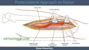 Posterolateral Approach To Femur Easily Explained | OrthoFixar