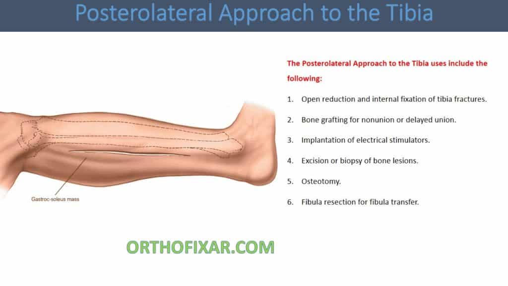 Posterolateral Approach To The Tibia • OrthoFixar 2025