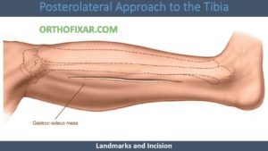 Posterolateral Approach To The Tibia • OrthoFixar 2025