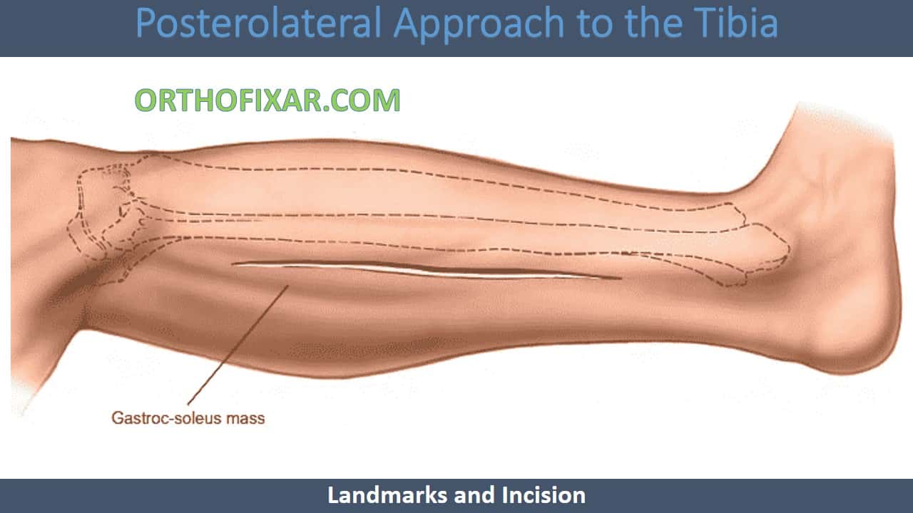 Posterolateral Approach To The Tibia • OrthoFixar 2025