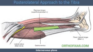 Posterolateral Approach To The Tibia • OrthoFixar 2025