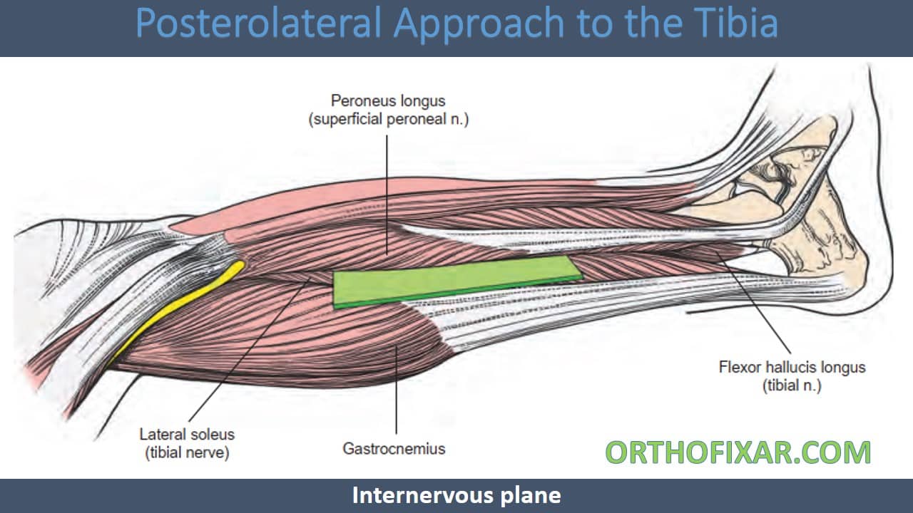 Posterolateral Approach To The Tibia • OrthoFixar 2025