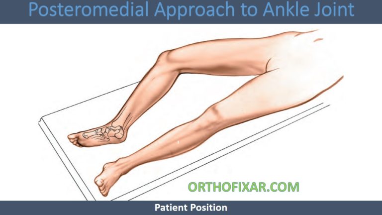Posteromedial Approach To Ankle Joint Easily Explained | OrthoFixar