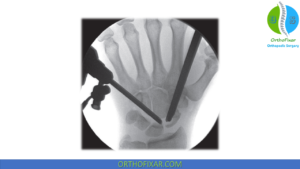 Proximal Row Carpectomy Easily Step-By-Step | OrthoFixar