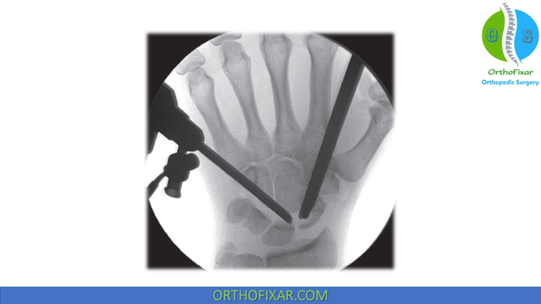 Proximal Row Carpectomy