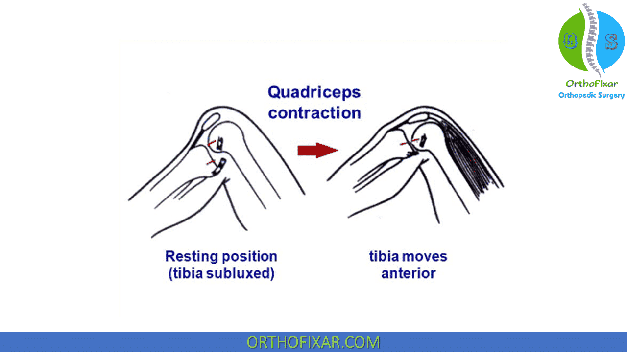 Quadriceps Active Test Explained Easily | OrthoFixar