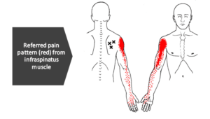 Understanding Infraspinatus Muscle Pain: Causes, Symptoms, And ...