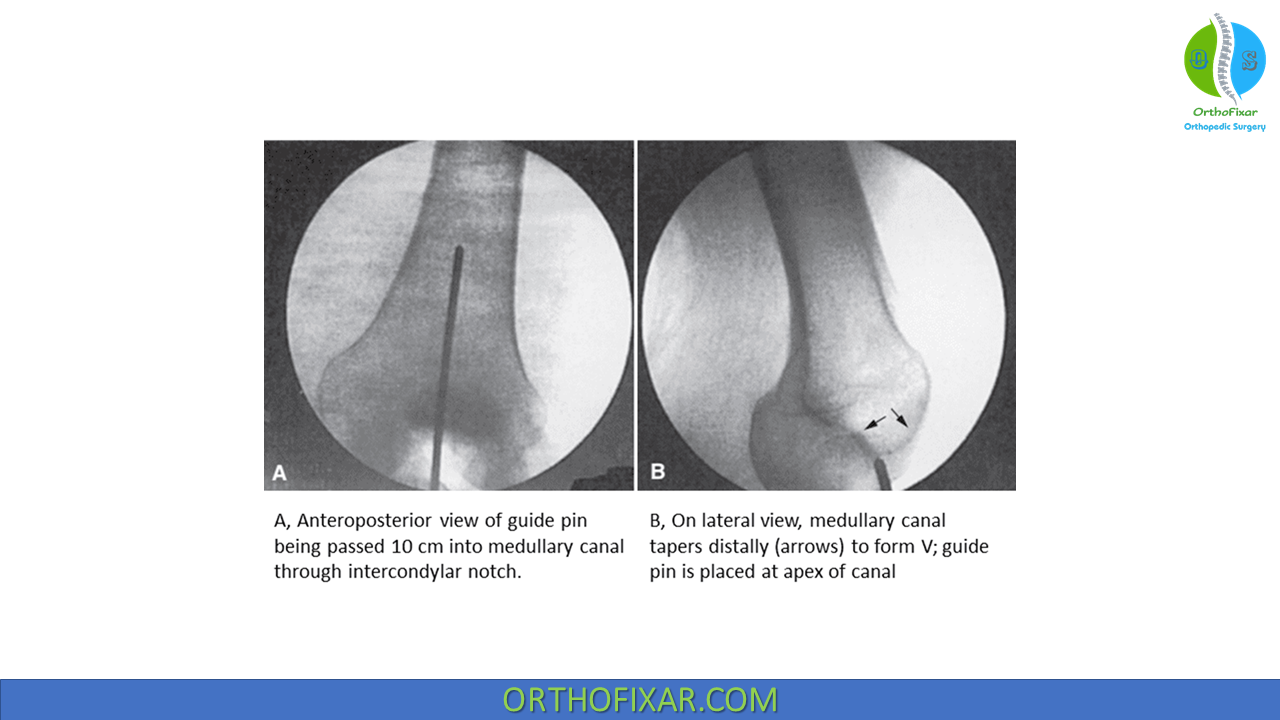 Retrograde Femoral Nailing Easily Step-By-Step | OrthoFixar