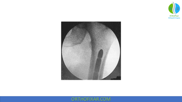 Retrograde Femoral Nailing Easily Step-By-Step | OrthoFixar