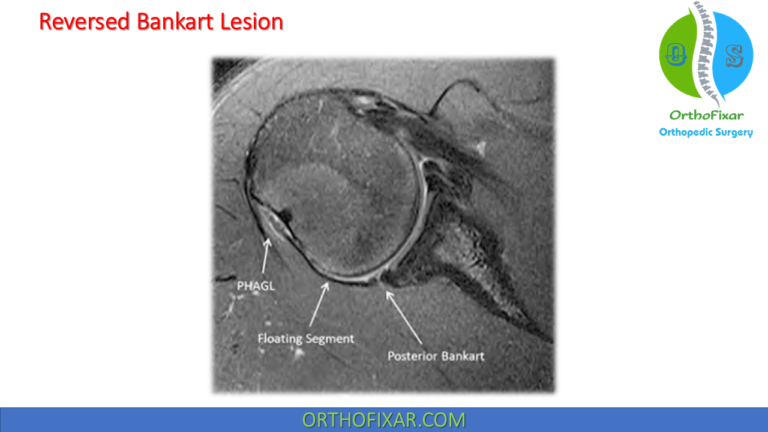 Bankart Lesion 2025 | Shoulder Dislocation
