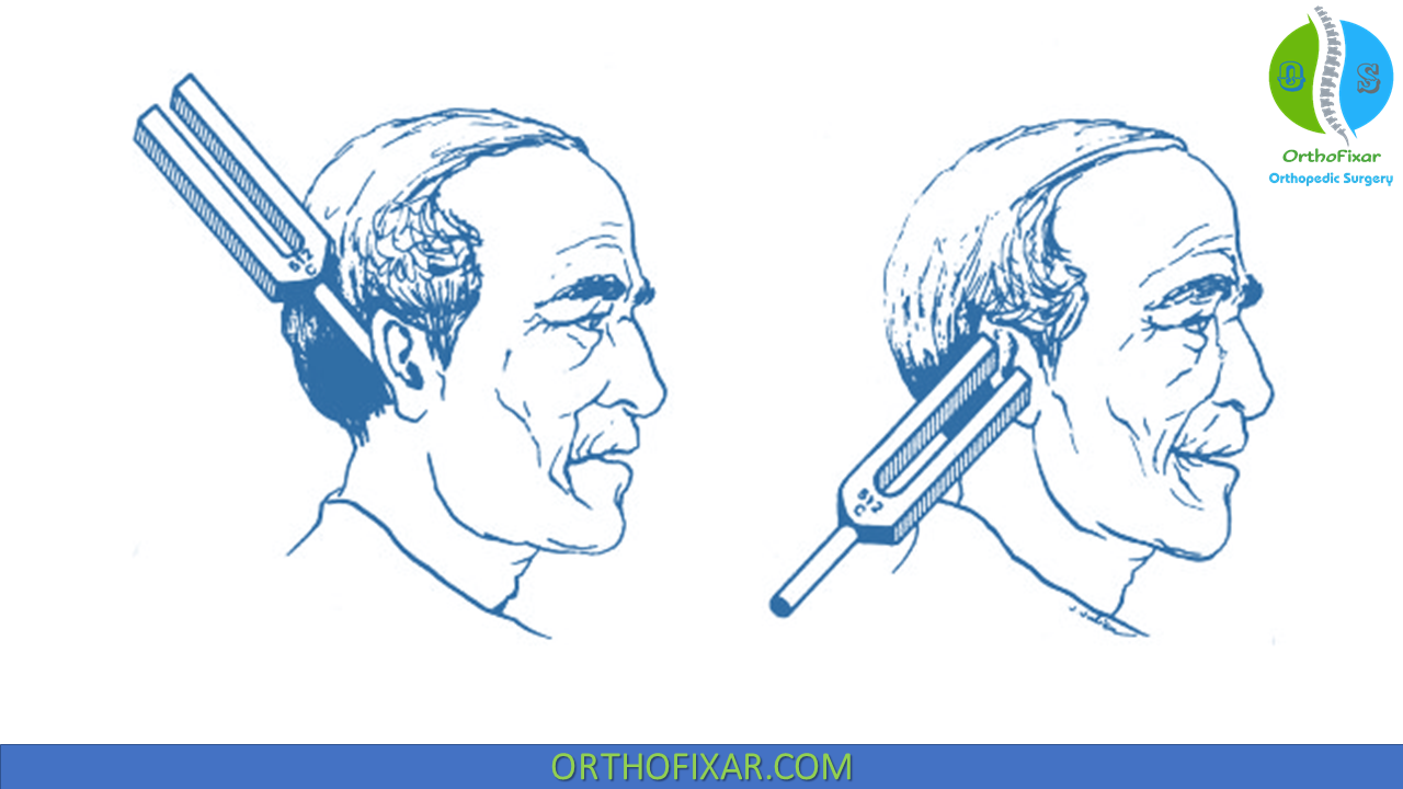 Rinne Test For Conductive Hearing Loss Explained Easily | OrthoFixar