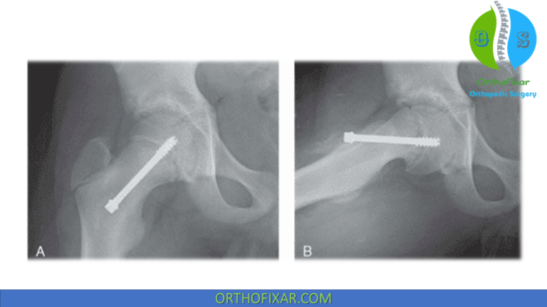 Slipped Capital Femoral Epiphysis | OrthoFixar 2025