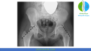 Slipped Capital Femoral Epiphysis | OrthoFixar 2025