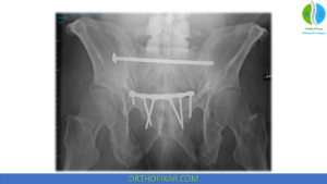 Sacroiliac Joint Dislocation - Full Review | OrthoFixar 2025