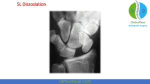 SNAC And SLAC Of The Wrist | OrthoFixar