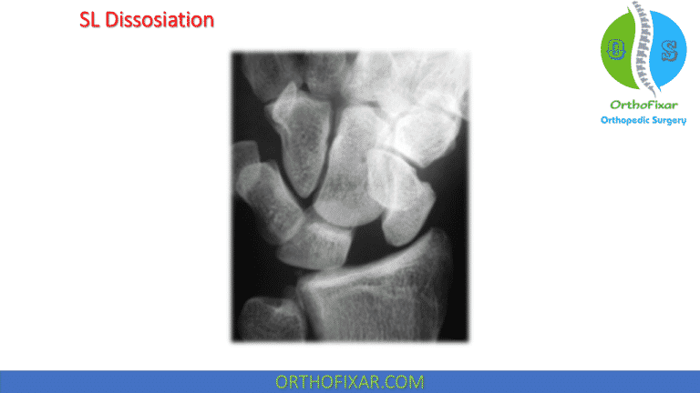SNAC And SLAC Of The Wrist | OrthoFixar