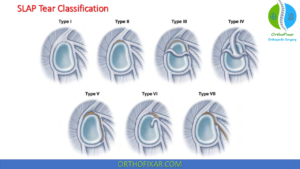Shoulder SLAP Lesion | OrthoFixar
