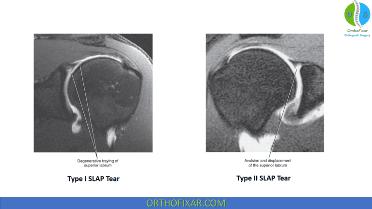 Shoulder SLAP Lesion