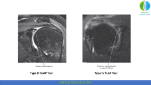 Shoulder SLAP Lesion | OrthoFixar