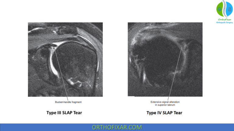 Shoulder SLAP Lesion | OrthoFixar