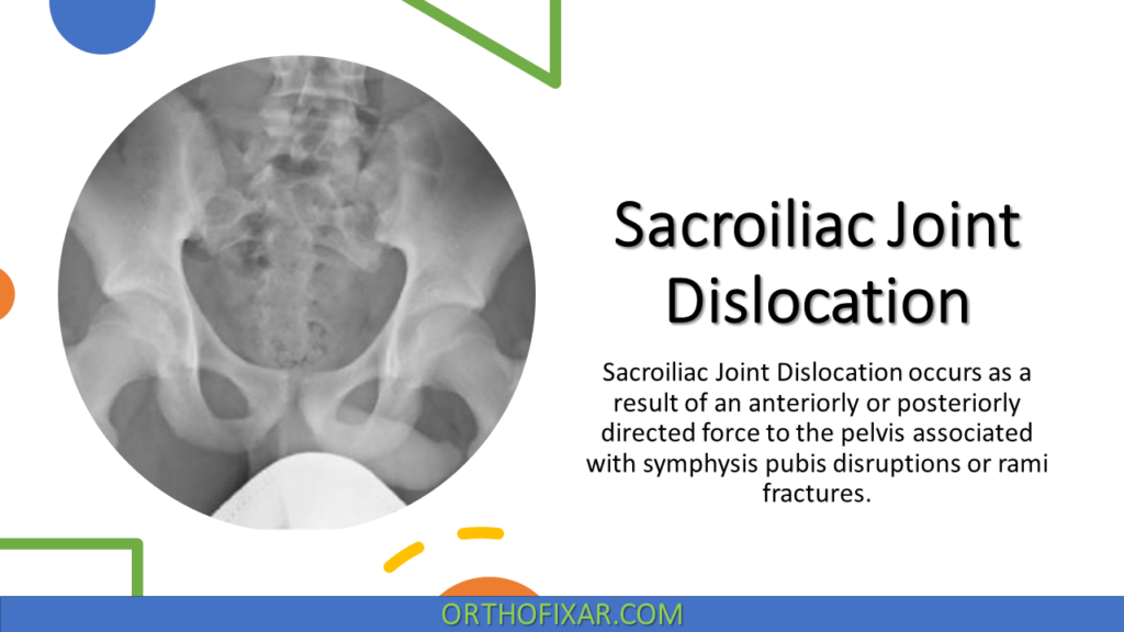 Sacroiliac Joint Dislocation - Full Review | OrthoFixar 2026