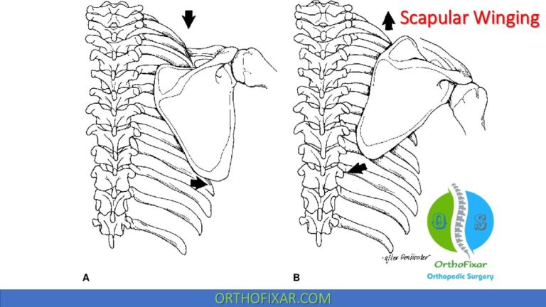 Scapular Winging Test Explained Easily | OrthoFixar