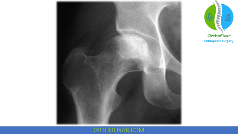 Osteonecrosis Of The Hip - Easy Explained | OrthoFixar 2025