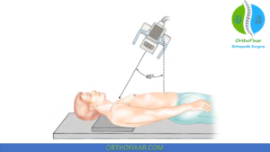 Sternoclavicular Joint Dislocation