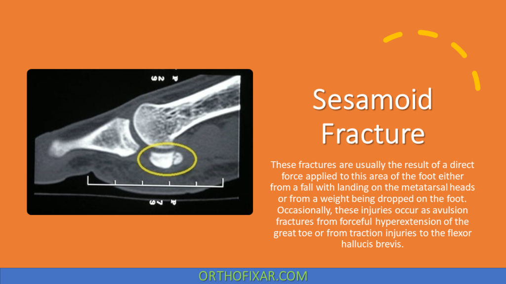 Sesamoid Fracture (broken Sesamoid) | OrthoFixar