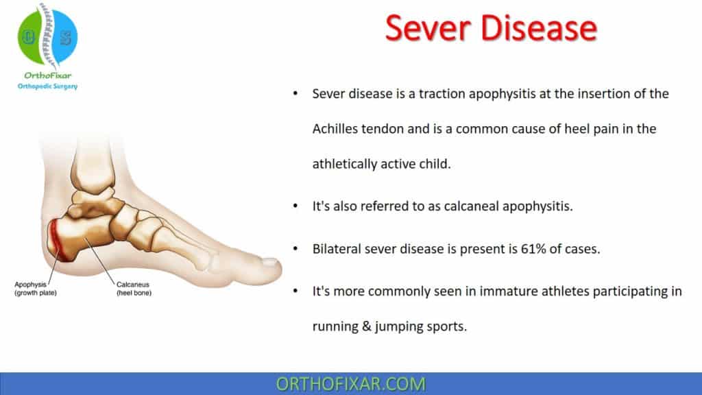 Sever Disease Radiology, Symptoms & Treatment